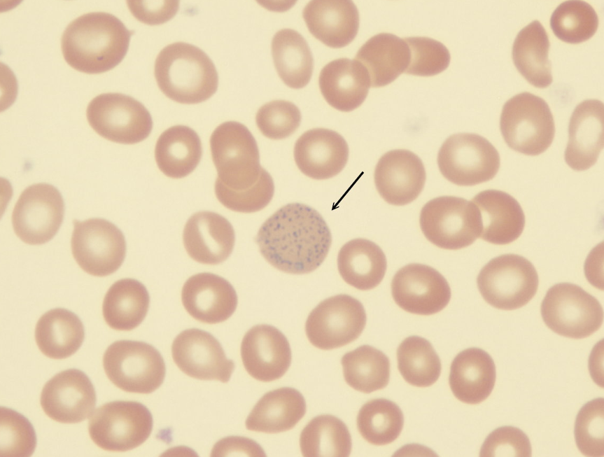 Lead Poisoning Medlibes Online Medical Library